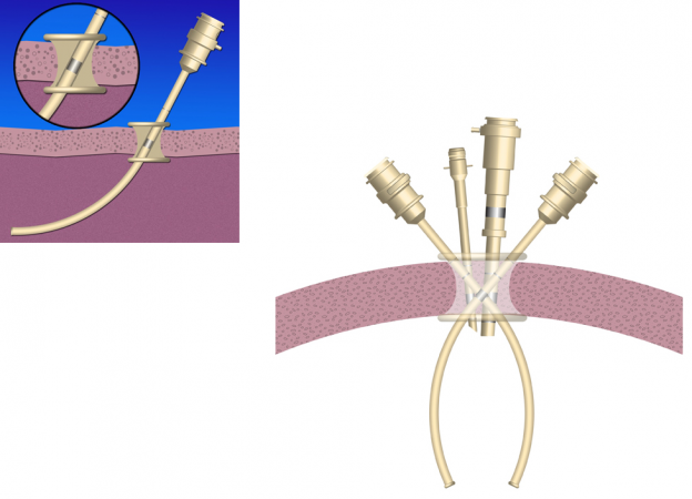 Robotic Surgery Los Angeles, Robotic Gallbladder Removal Beverly Hills ...